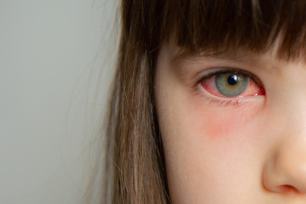 Pink Eye: Causes, Treatment and Prevention - Texas Health Care